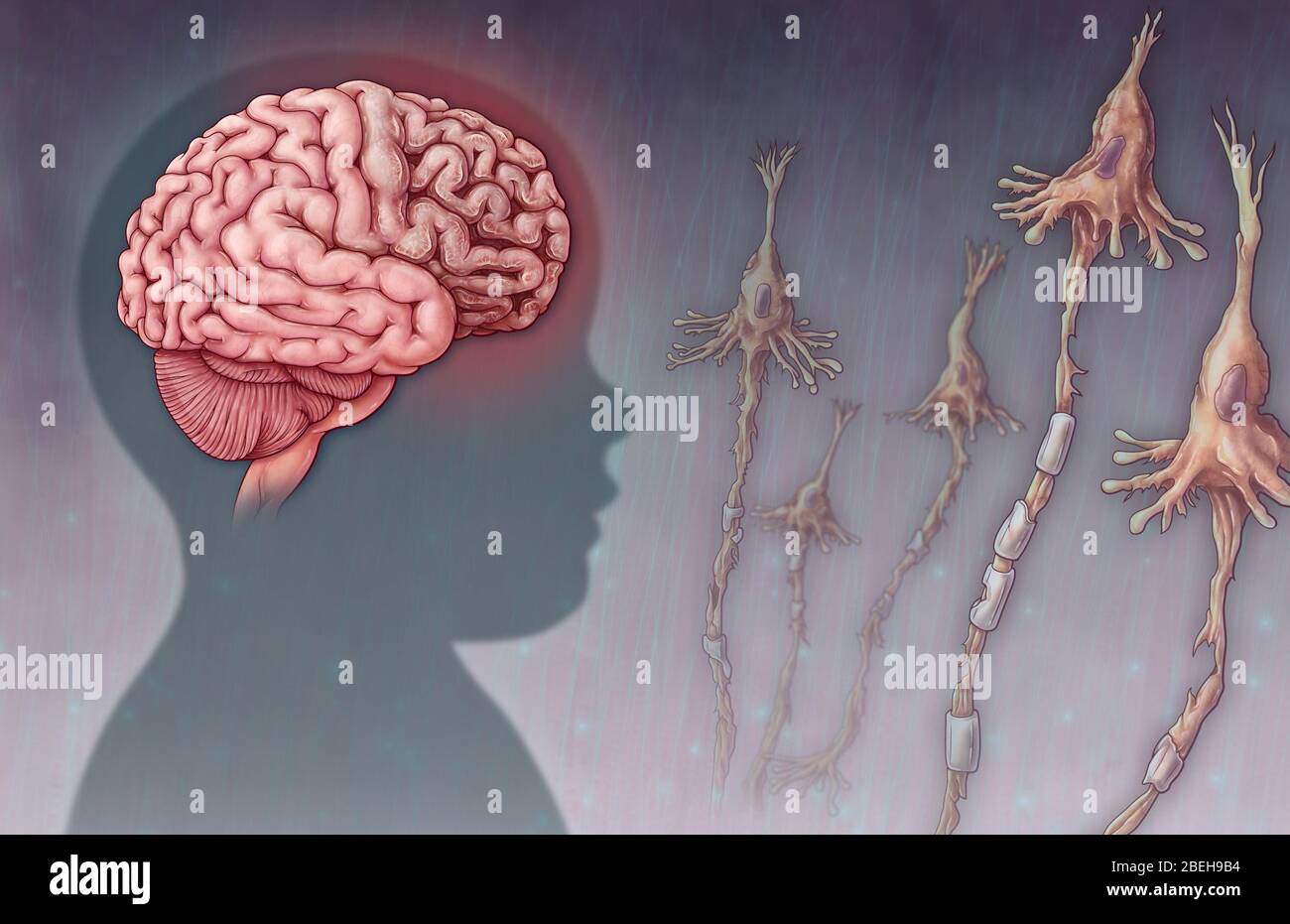 Tay-sachs Disease, illustration Stock Photo - Alamy