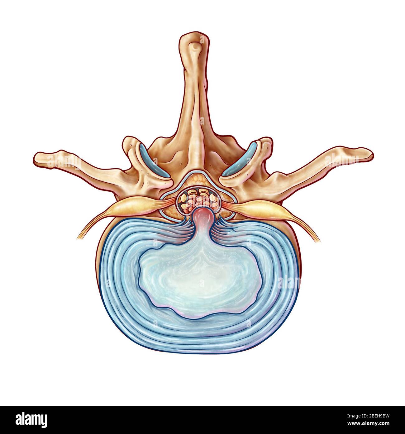 Herniated Disk, illustration Stock Photo - Alamy