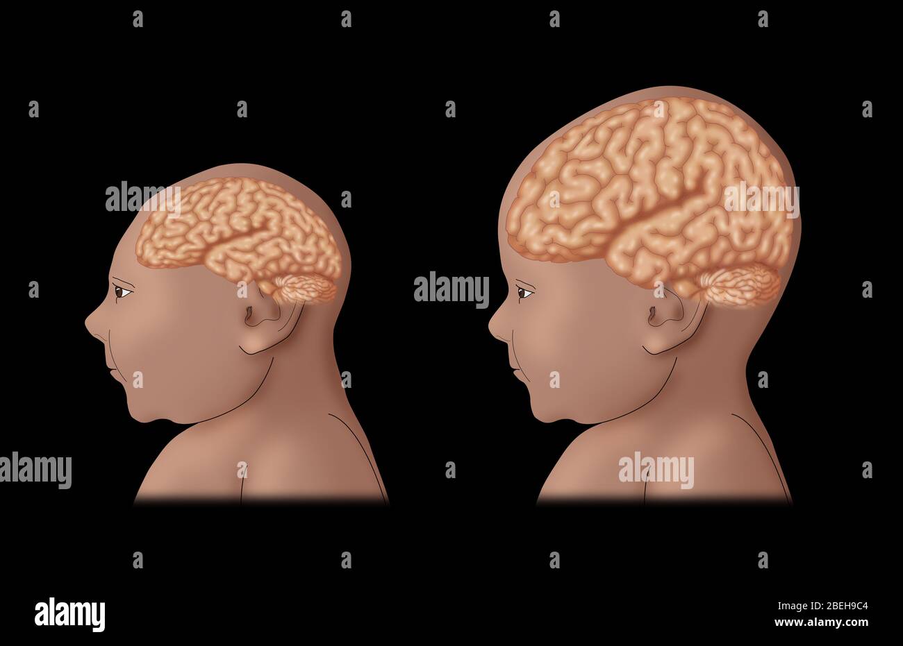 Microcephaly High Resolution Stock Photography and Images - Alamy