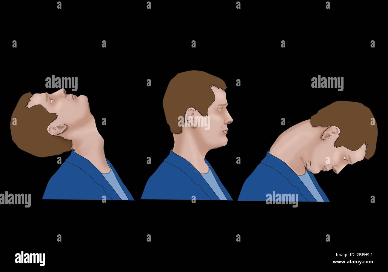 Cervical whiplash hi-res stock photography and images - Alamy