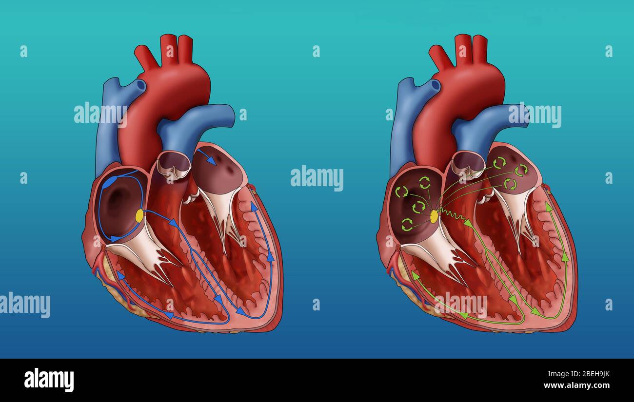 Heart and Atrial Fibrillation, Illustration Stock Photo - Alamy