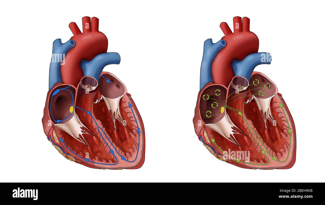 Heart and Atrial Fibrillation, Illustration Stock Photo - Alamy