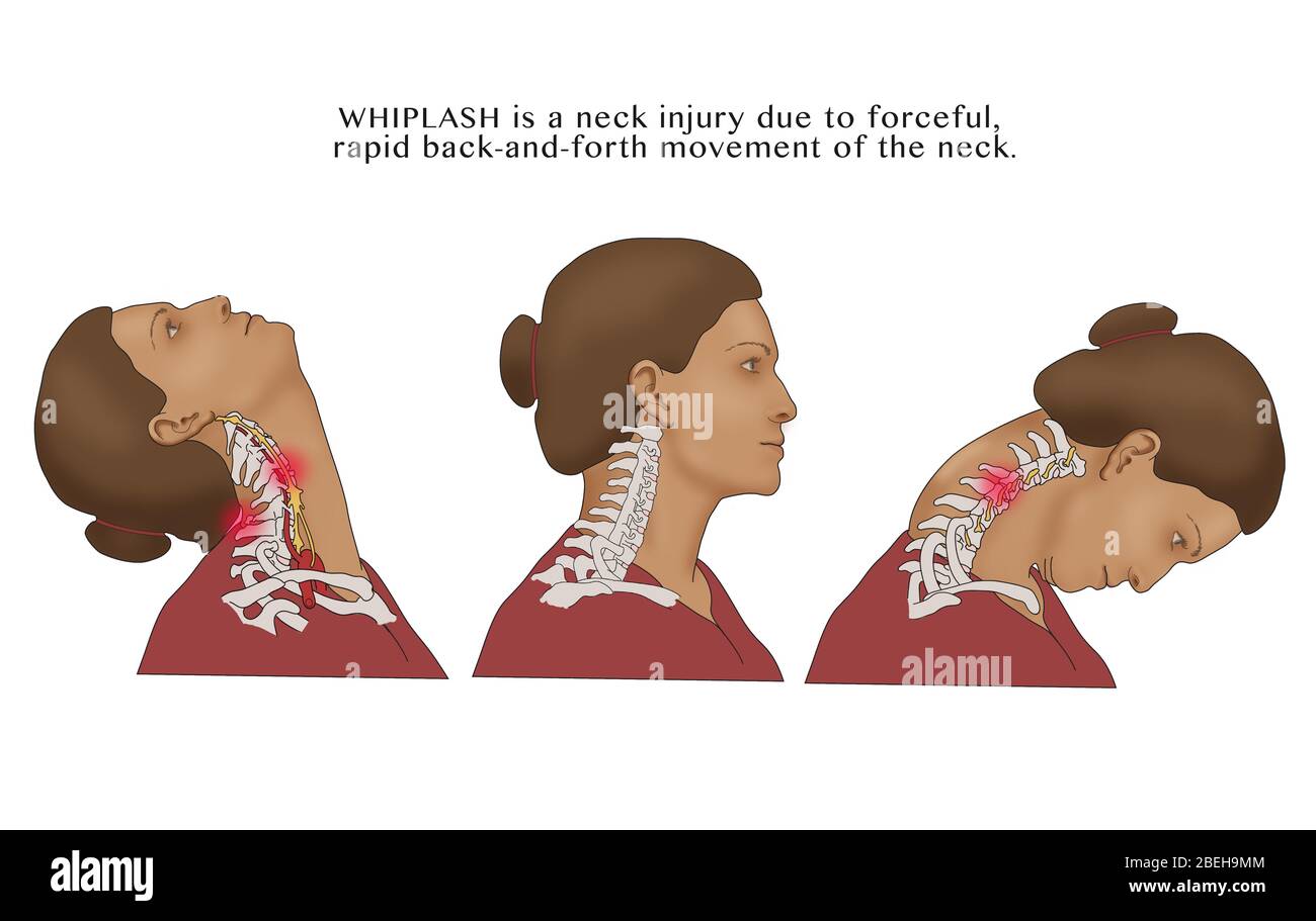 Hyperflexion hyperextension hi-res stock photography and images - Alamy