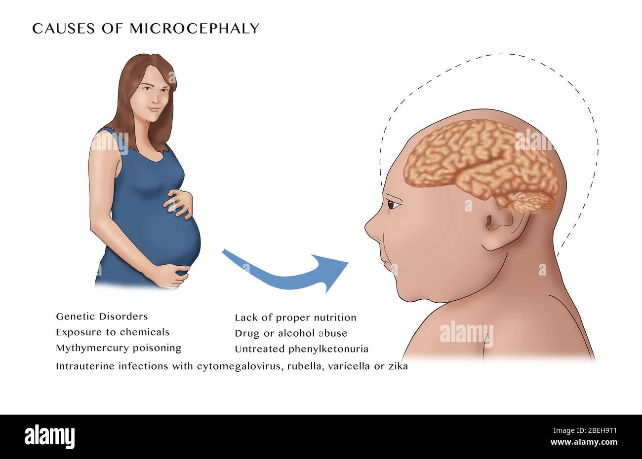 Congenital cephalic disorder hi-res stock photography and images - Alamy