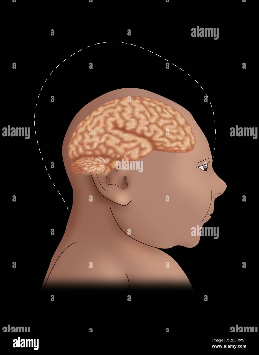 Microcephaly brain hi-res stock photography and images - Alamy