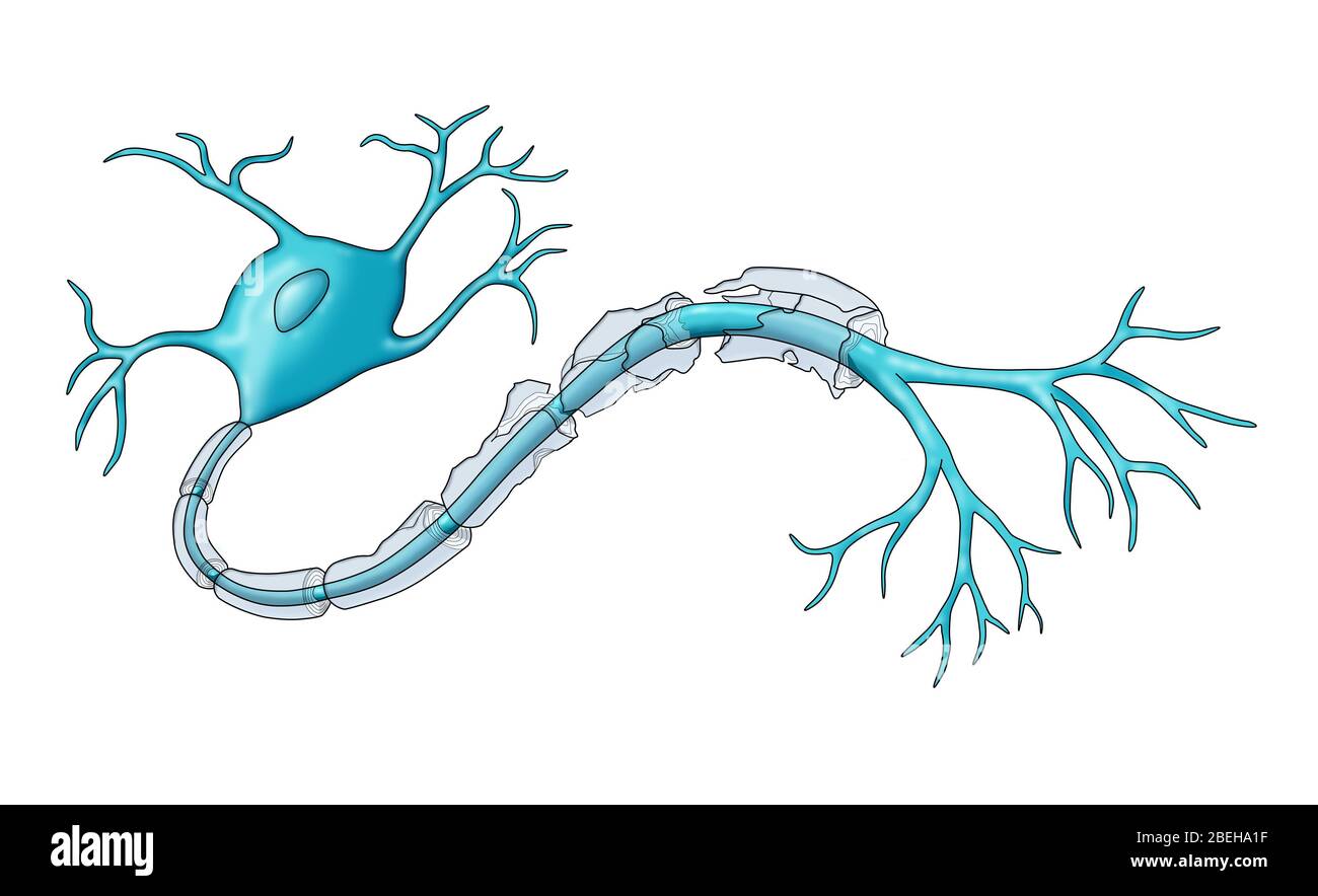 Multiple sclerosis demyelination myelin Cut Out Stock Images & Pictures ...