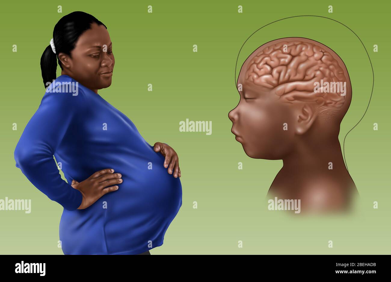 Microcephaly brain hi-res stock photography and images - Alamy