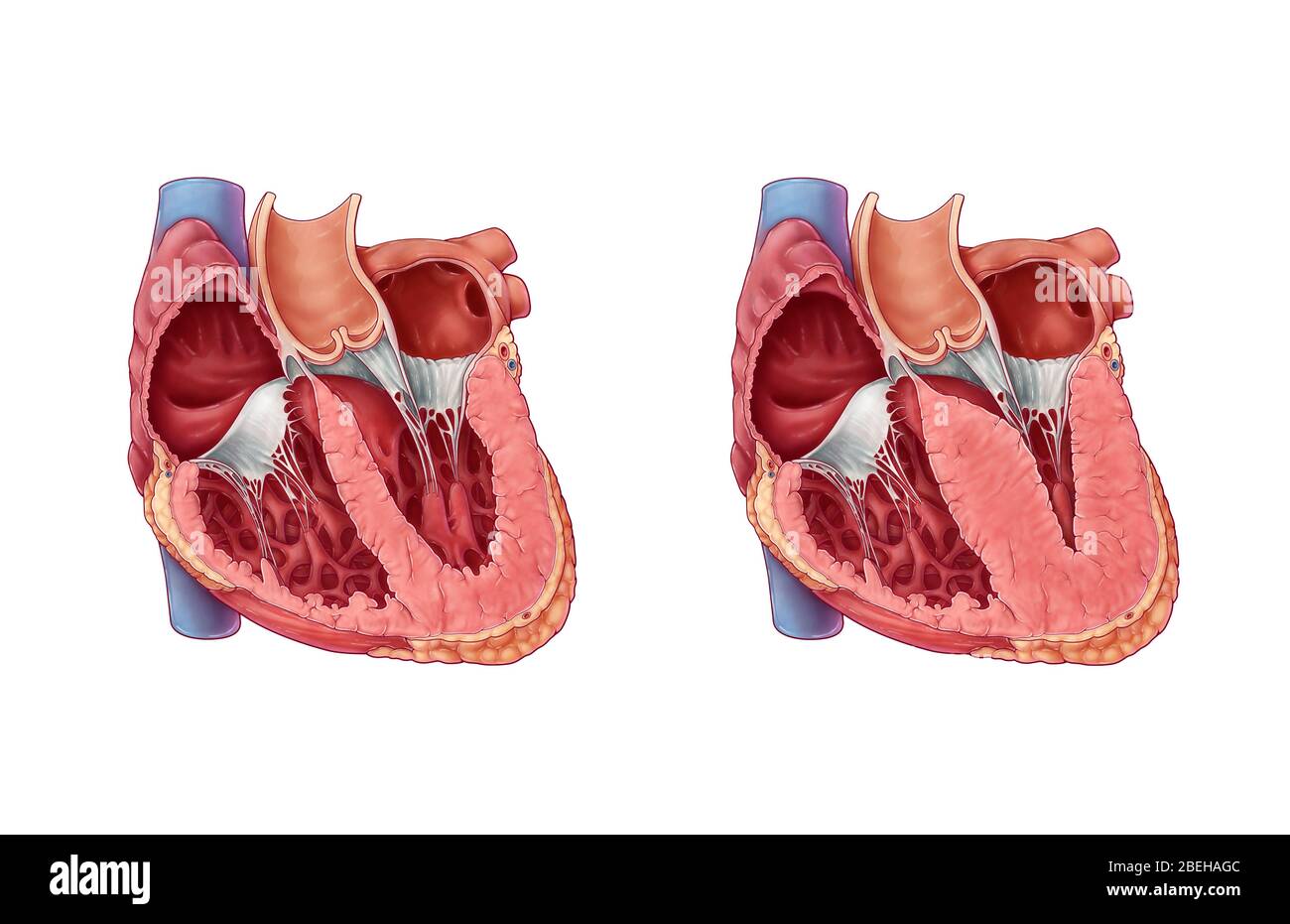 Cardiac hypertrophy hi-res stock photography and images - Alamy