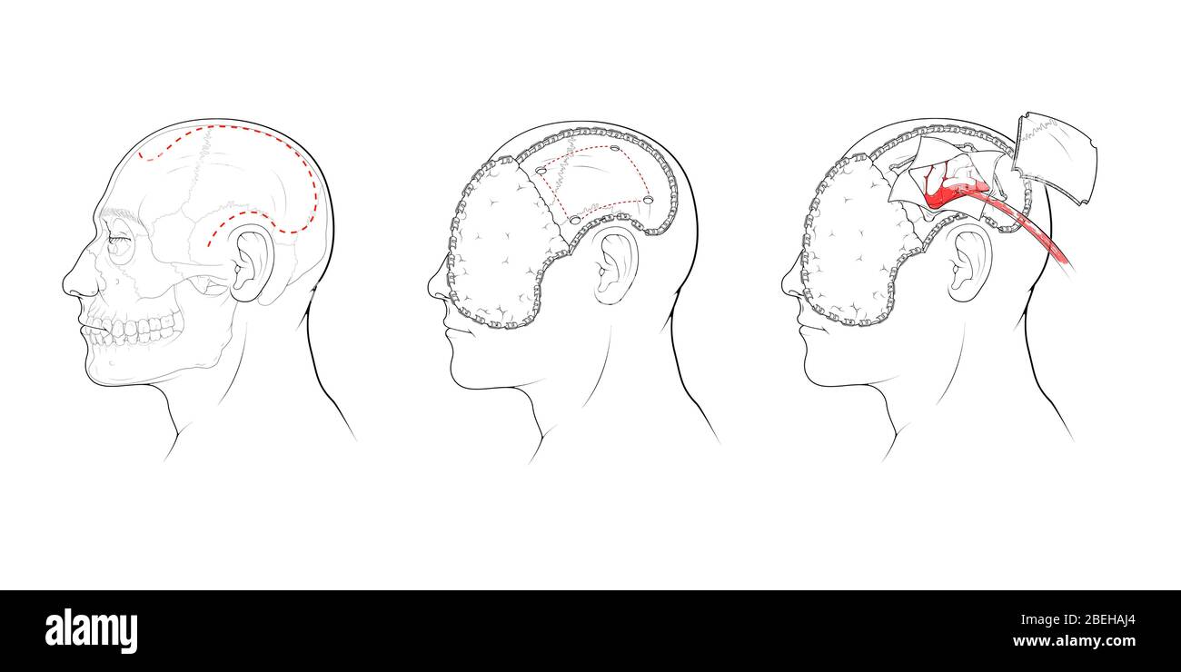 Craniectomy hi-res stock photography and images - Alamy