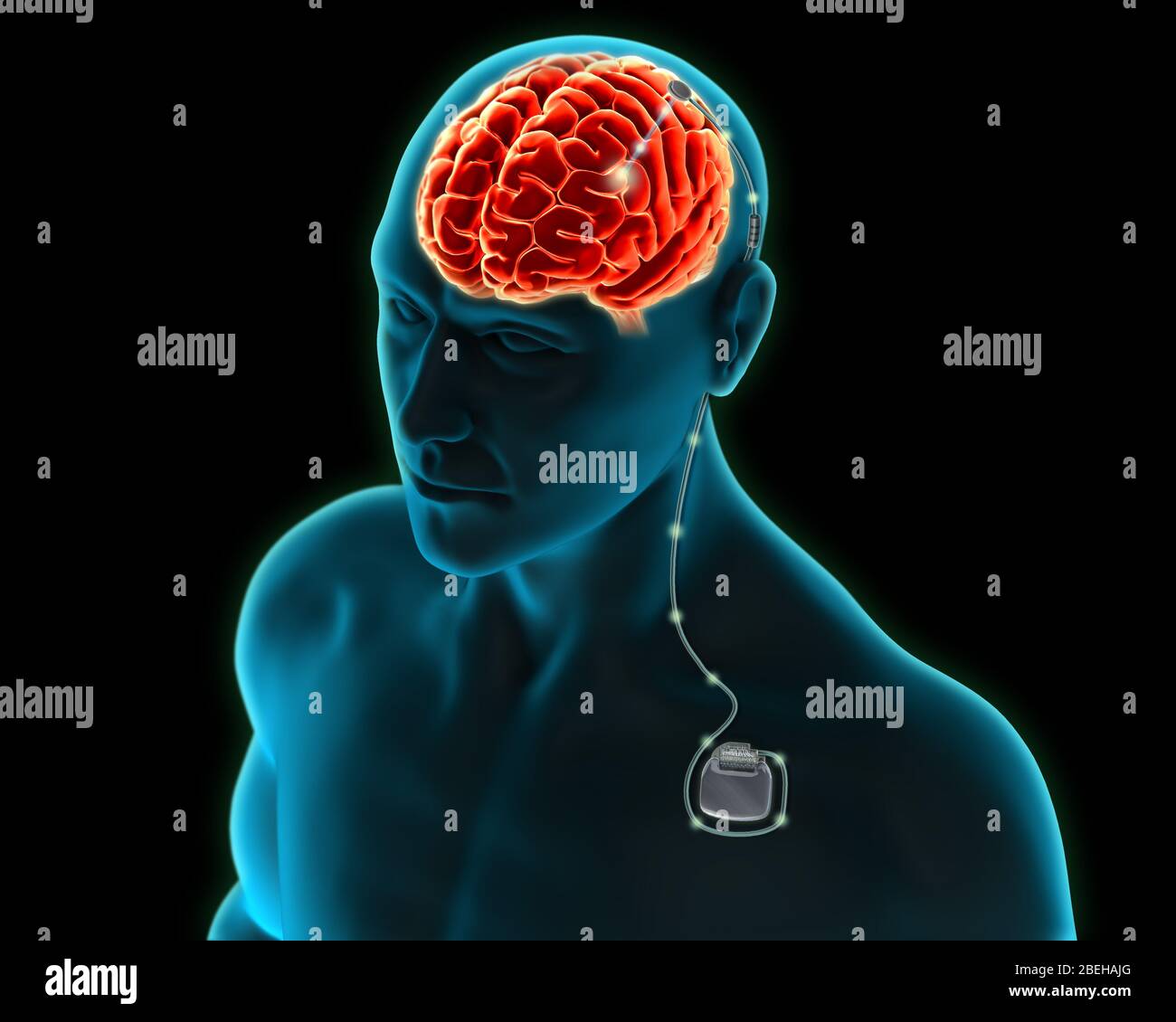 Deep Brain Stimulation, Illustration Stock Photo - Alamy
