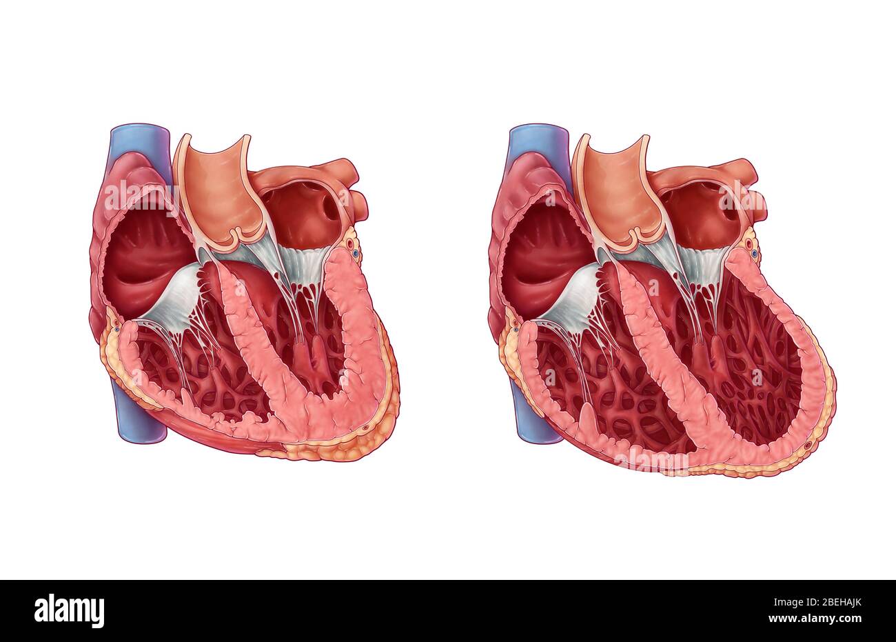 Enlarged heart hi-res stock photography and images - Alamy