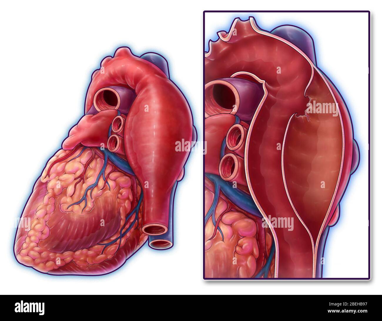 Aortic dissection hi-res stock photography and images - Alamy