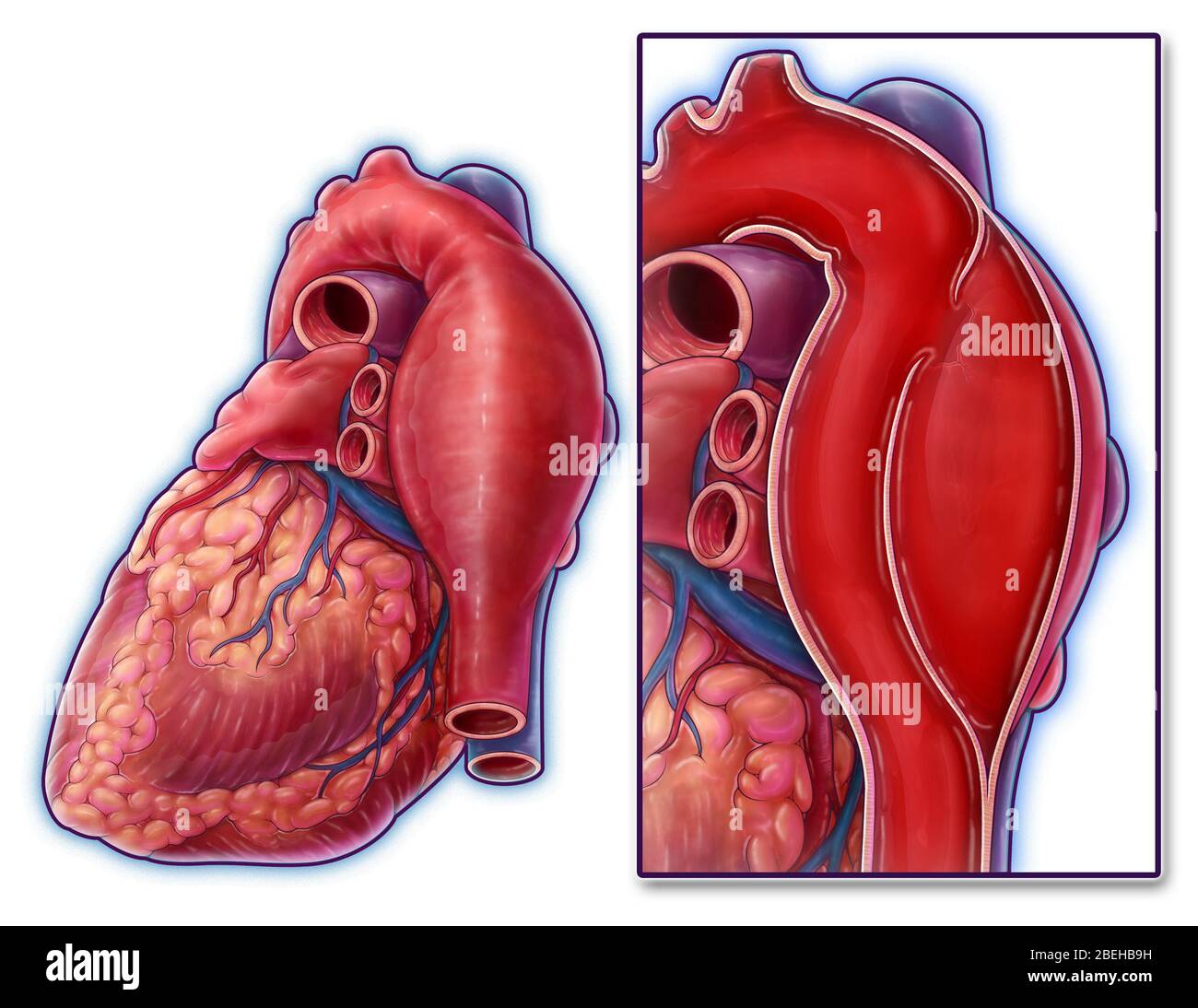 Aortic dissection Cut Out Stock Images & Pictures - Alamy
