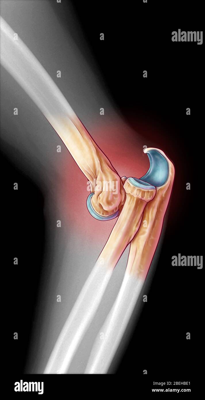Dislocation elbow hi-res stock photography and images - Alamy