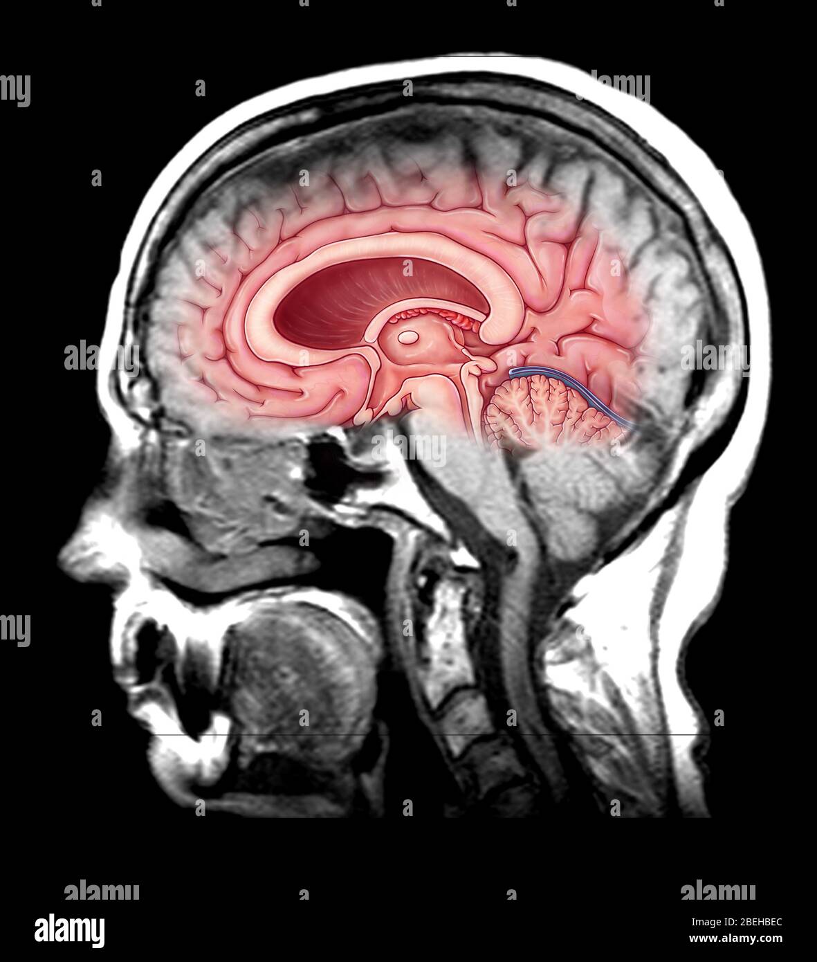 Congenital hydrocephalus hi-res stock photography and images - Alamy