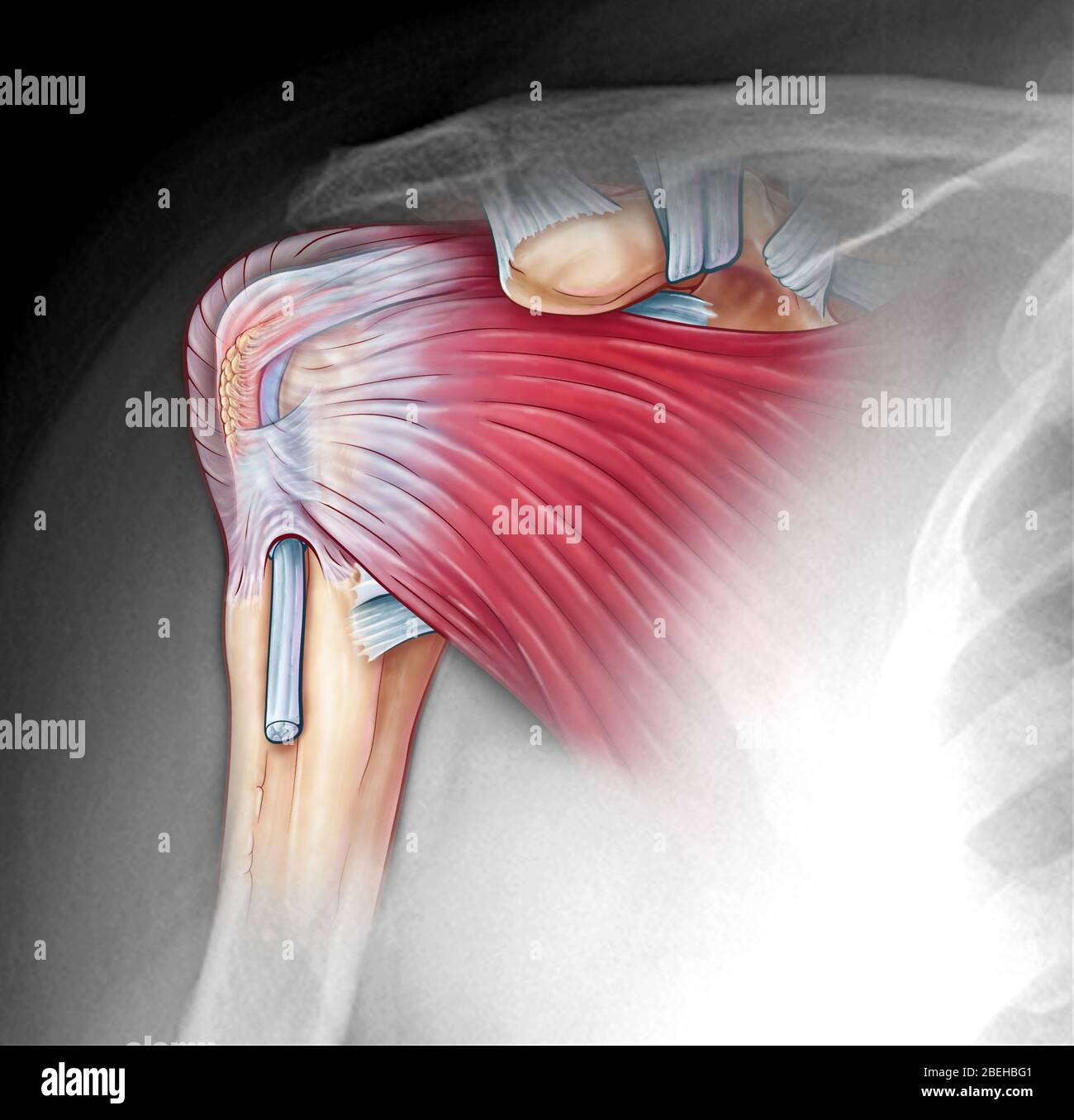 Tendinosis or tendinitis hi-res stock photography and images - Alamy