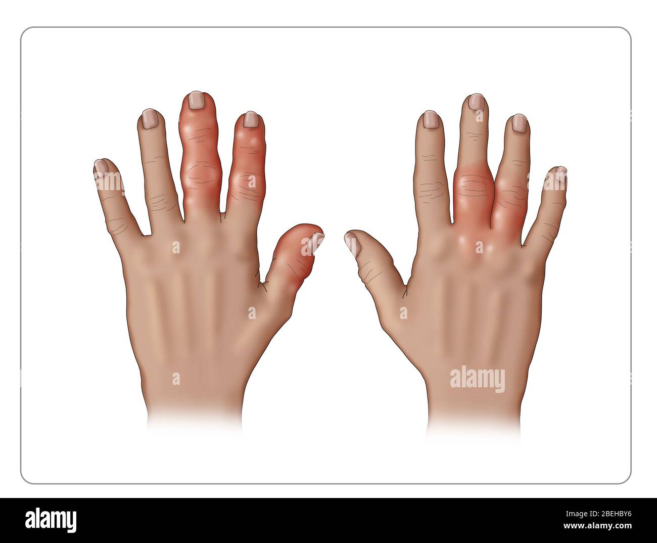 Medical arthritis Cut Out Stock Images & Pictures - Alamy