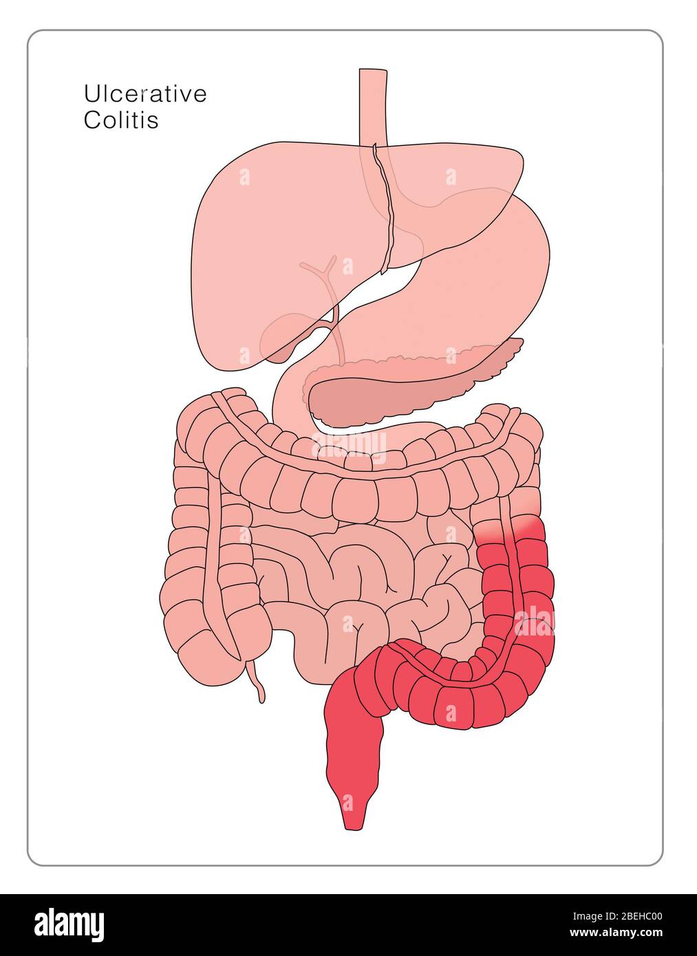 Ulcerative colitis hi-res stock photography and images - Alamy