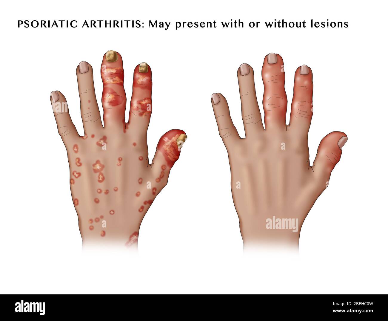 Psoriatic Arthritis with and without Lesions Stock Photo - Alamy