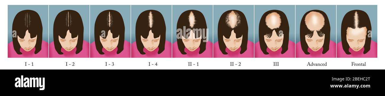 Stages of Female Hair Loss Stock Photo - Alamy