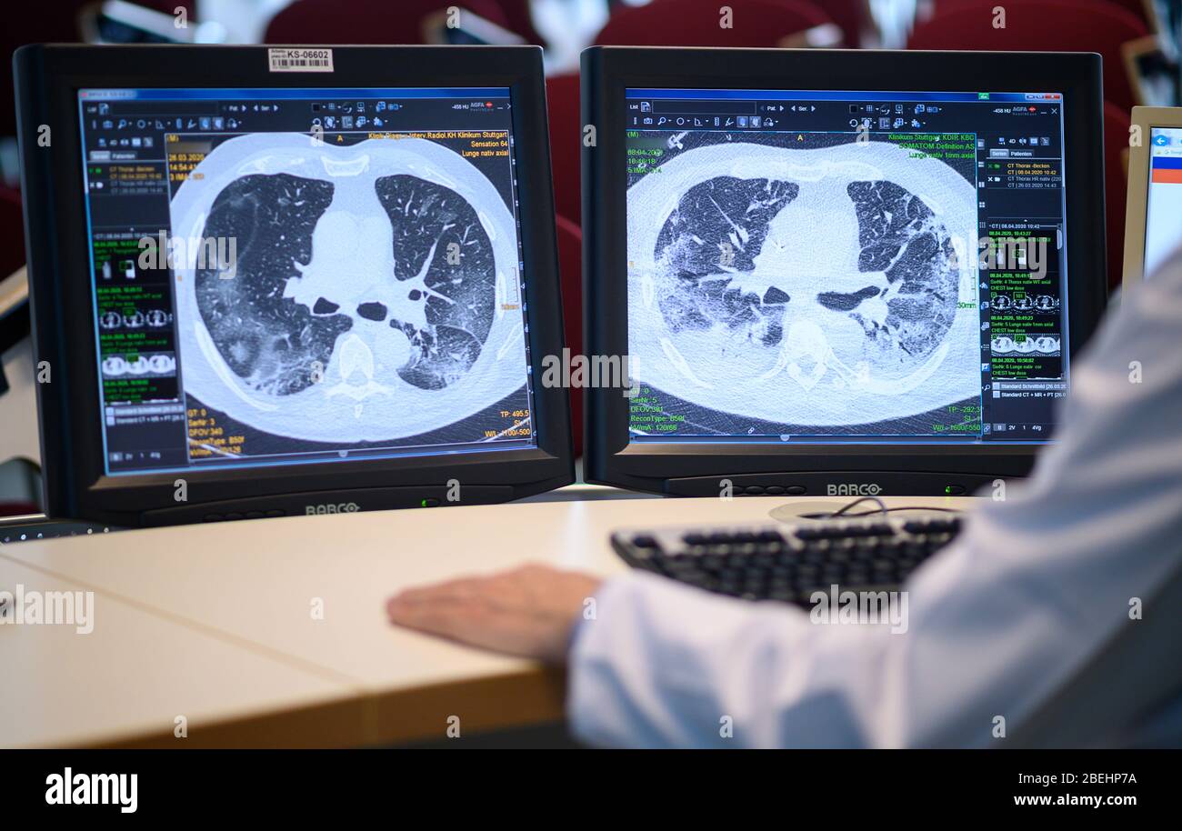 09 April 2020, Baden-Wuerttemberg, Stuttgart: Computed tomography ...