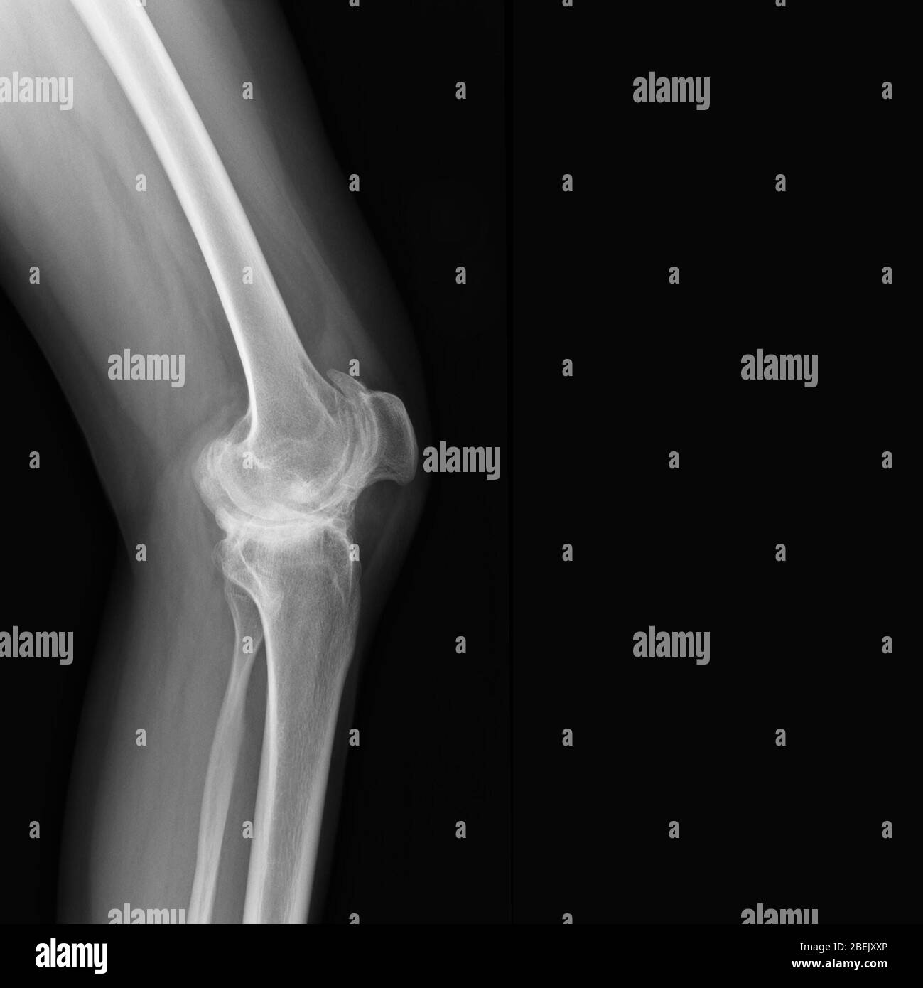 Knee replacement xray hi-res stock photography and images - Alamy