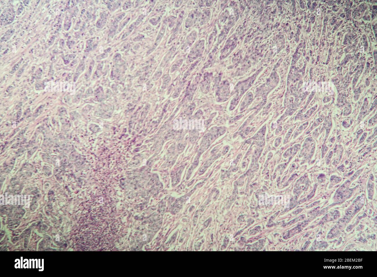 Cancer tissue of the stomach under the microscope 100x Stock Photo - Alamy