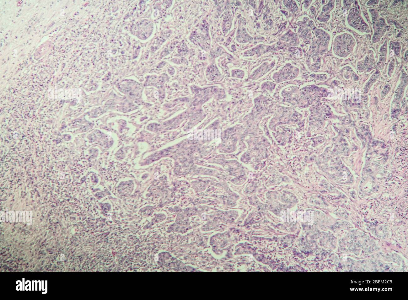 Cancer of the stomach histology hi-res stock photography and images - Alamy