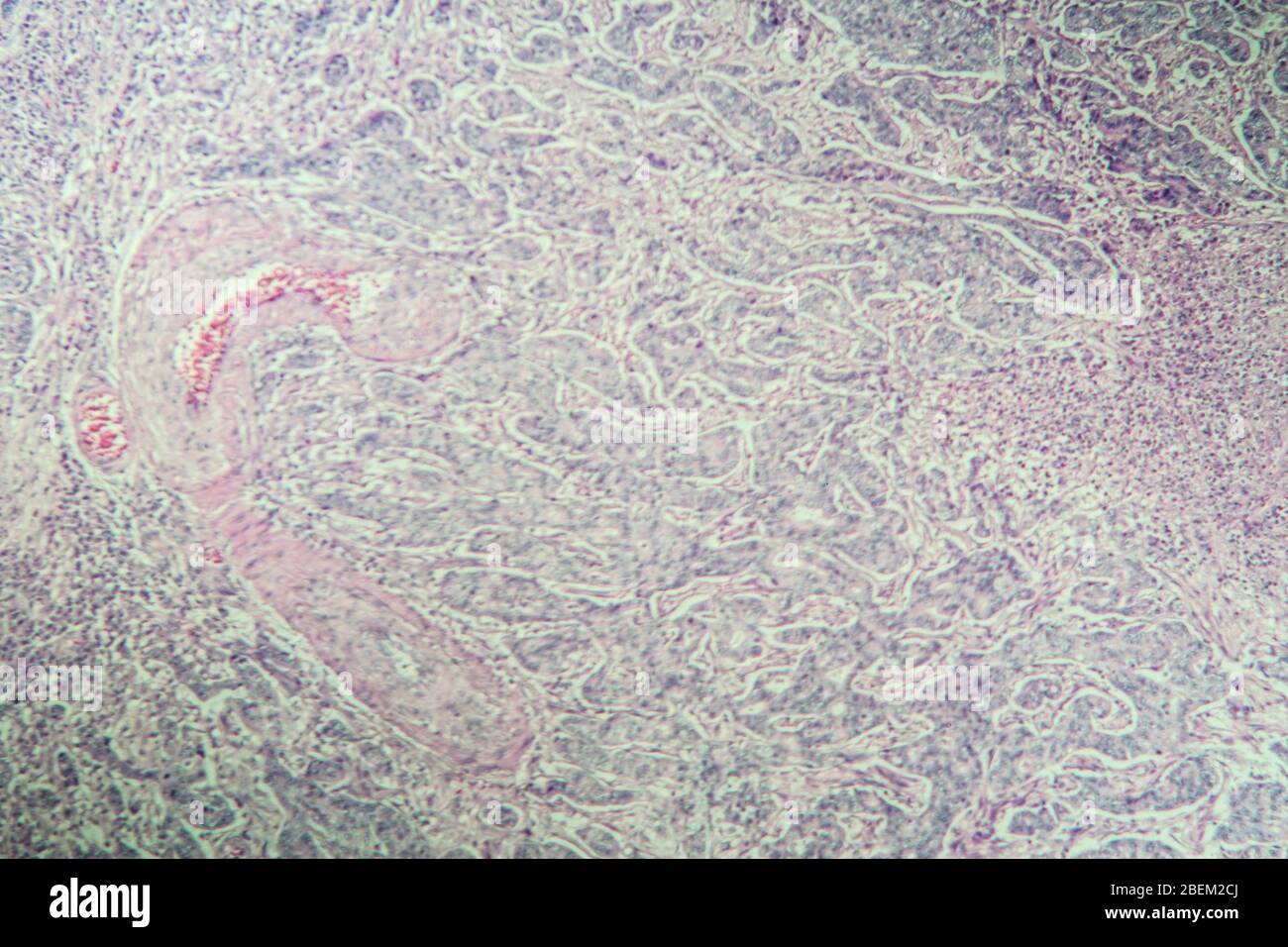 Stomach cancer tissue under the microscope 100x hi-res stock ...