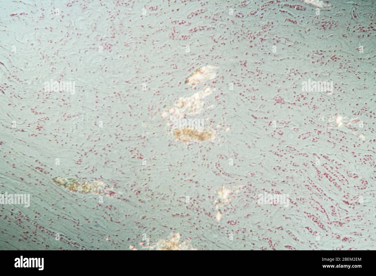 Gout crystals deposits in the kidney tissue under the microscope 100x ...