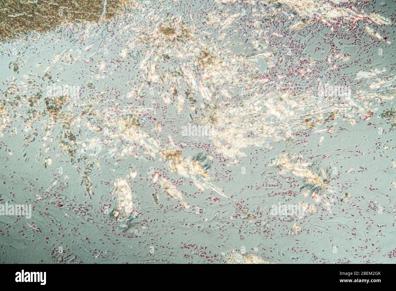 Gout crystals deposits in the kidney tissue under the microscope 100x ...