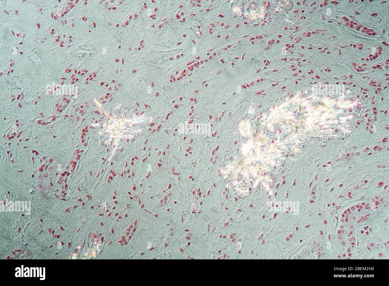 Gout crystals deposits in the kidney tissue under the microscope 100x ...