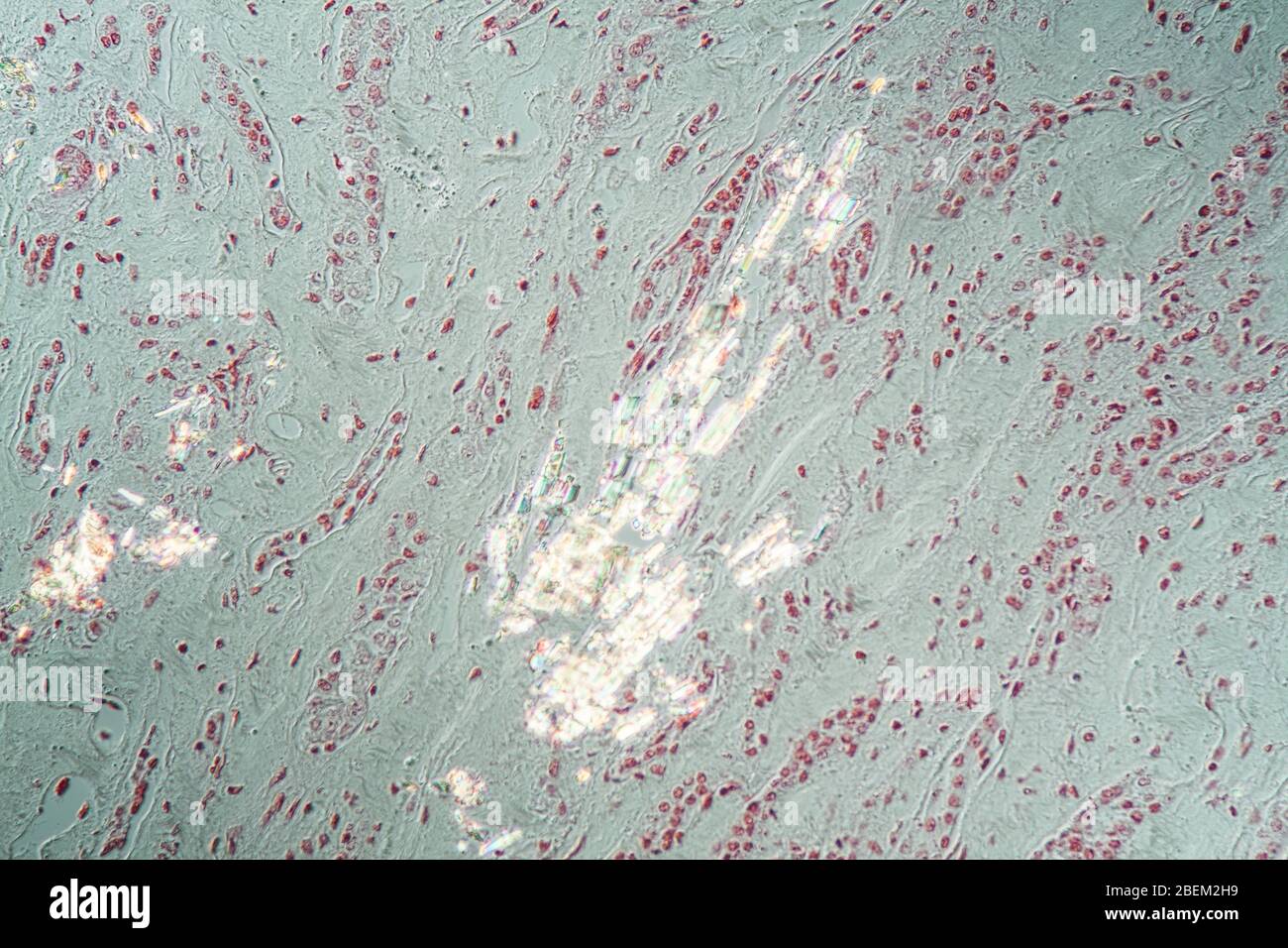 Gout crystals deposits in the kidney tissue under the microscope 100x ...