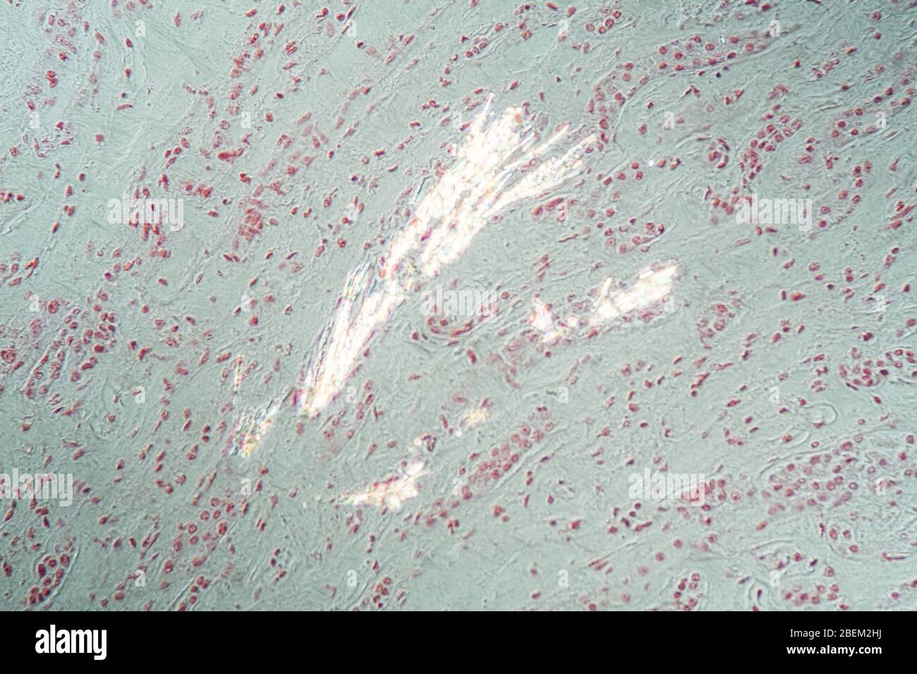 Gout Crystals Microscope