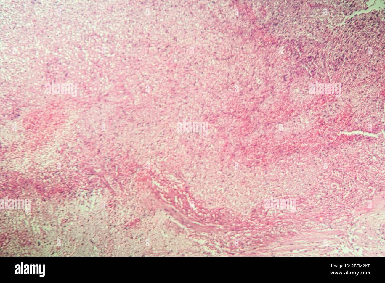 Gallbladder necrosis tissue under the microscope 100x Stock Photo - Alamy