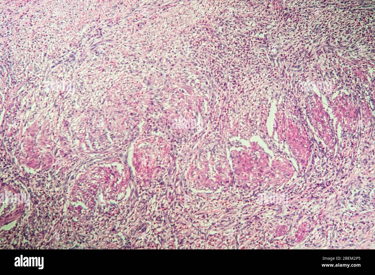 Gallbladder necrosis tissue under the microscope 100x Stock Photo - Alamy