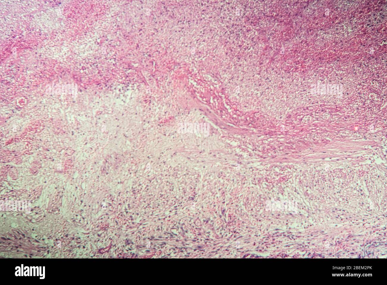 Gallbladder necrosis tissue under the microscope 100x Stock Photo - Alamy