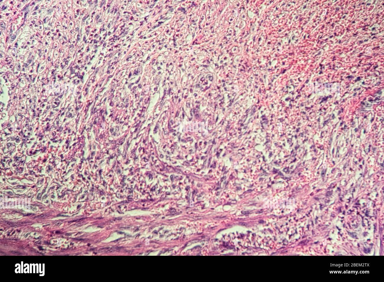 Gallbladder necrosis tissue under the microscope 100x Stock Photo - Alamy