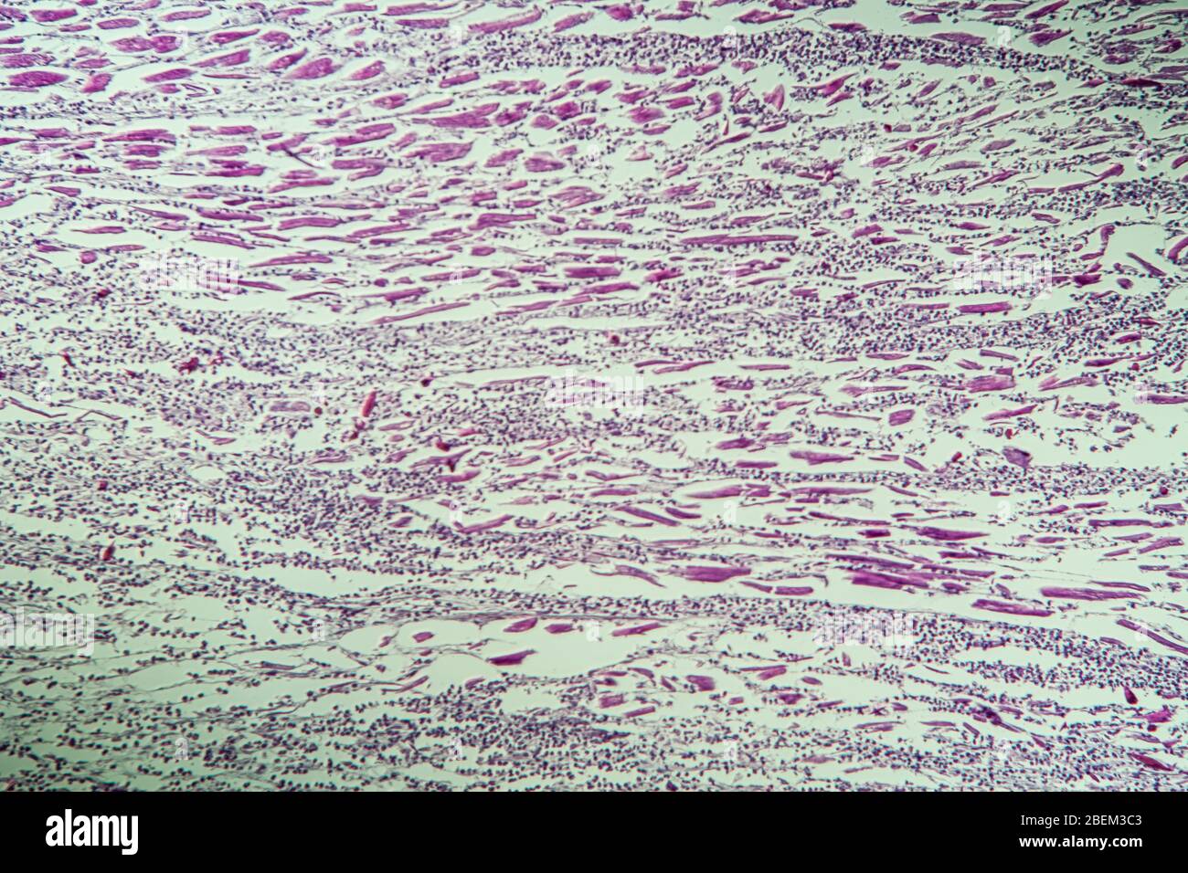 inflamed heart muscle as myocarditis 100x Stock Photo - Alamy