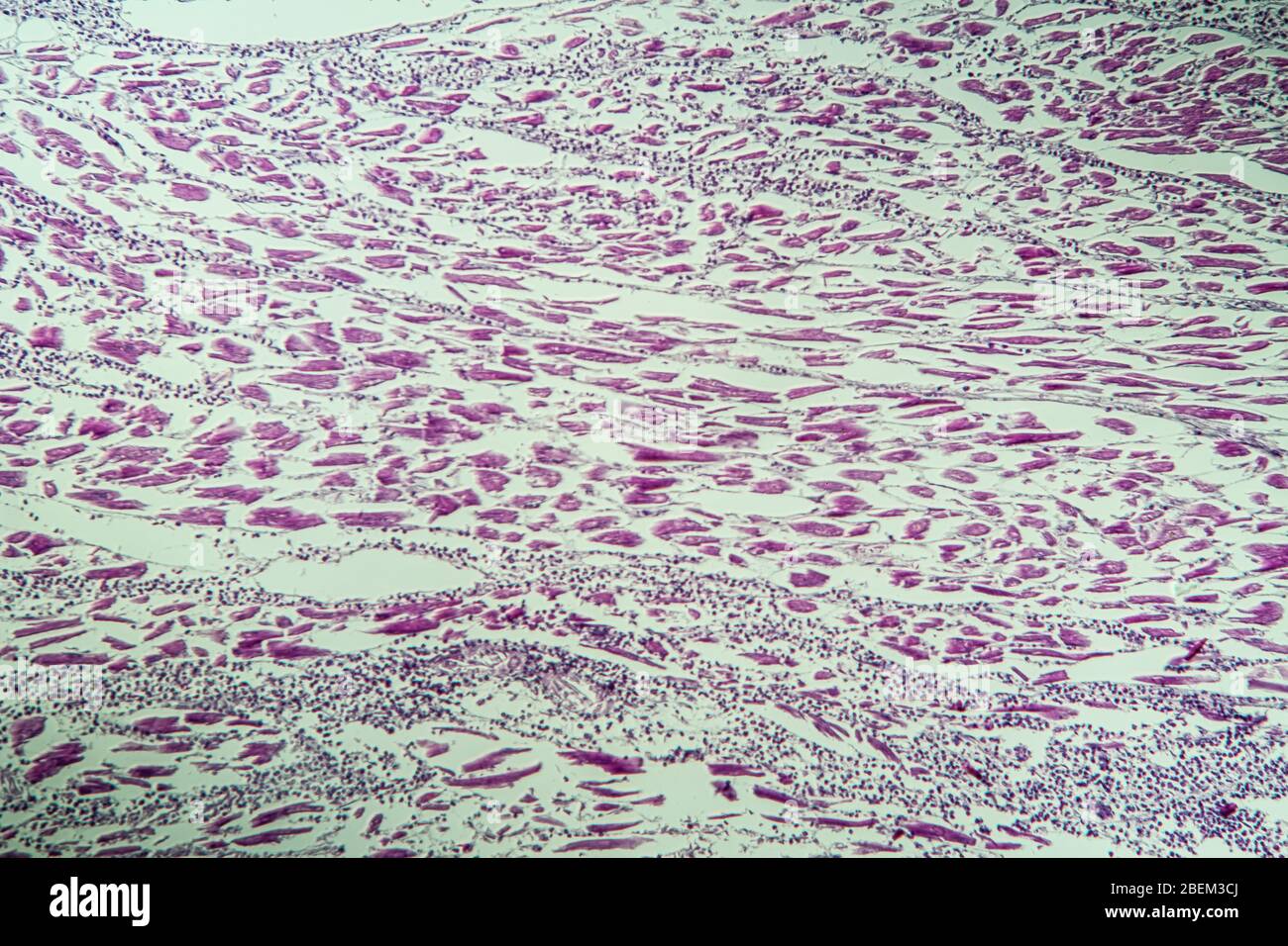 inflamed heart muscle as myocarditis 100x Stock Photo - Alamy