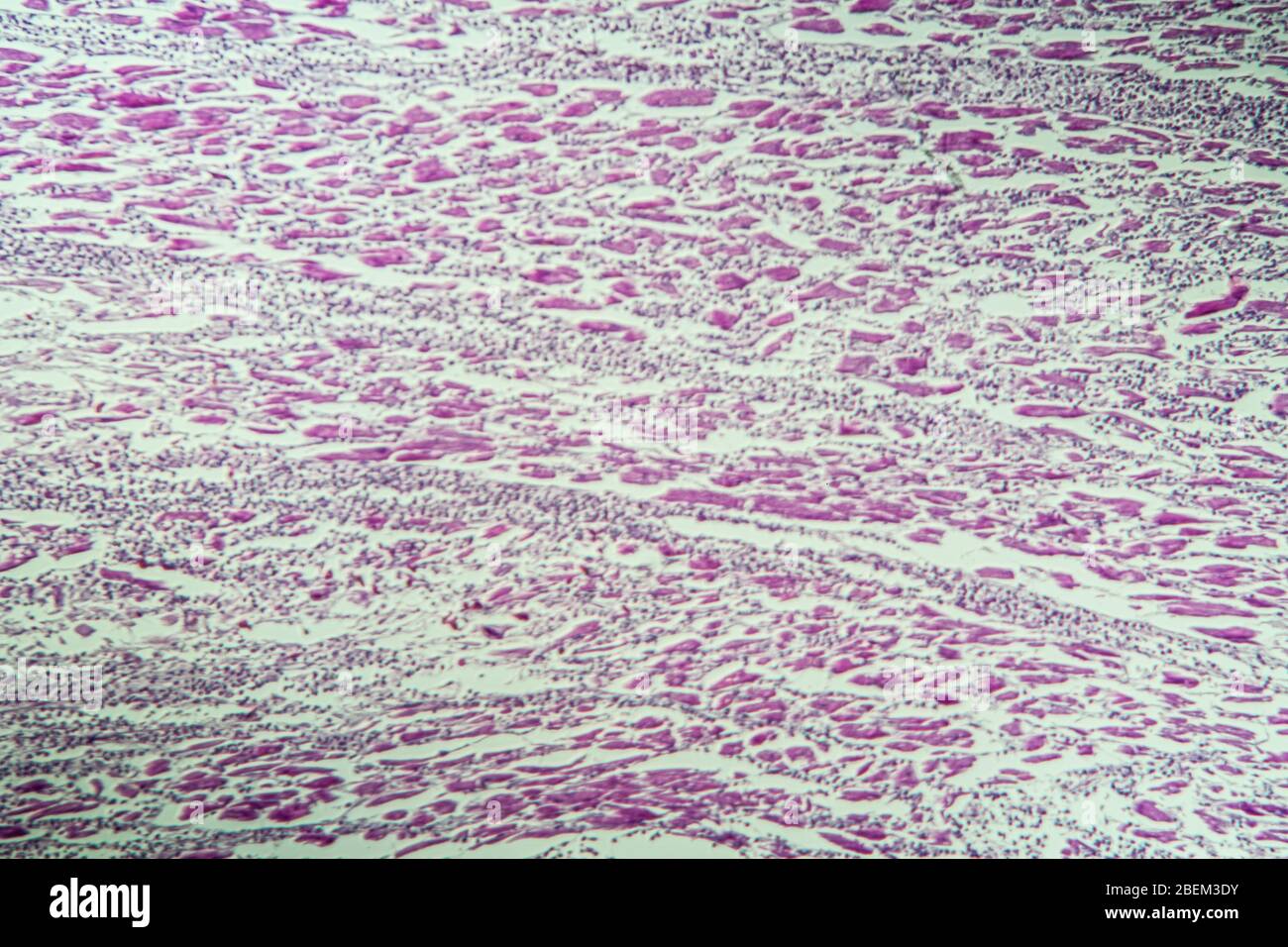 inflamed heart muscle as myocarditis 100x Stock Photo - Alamy