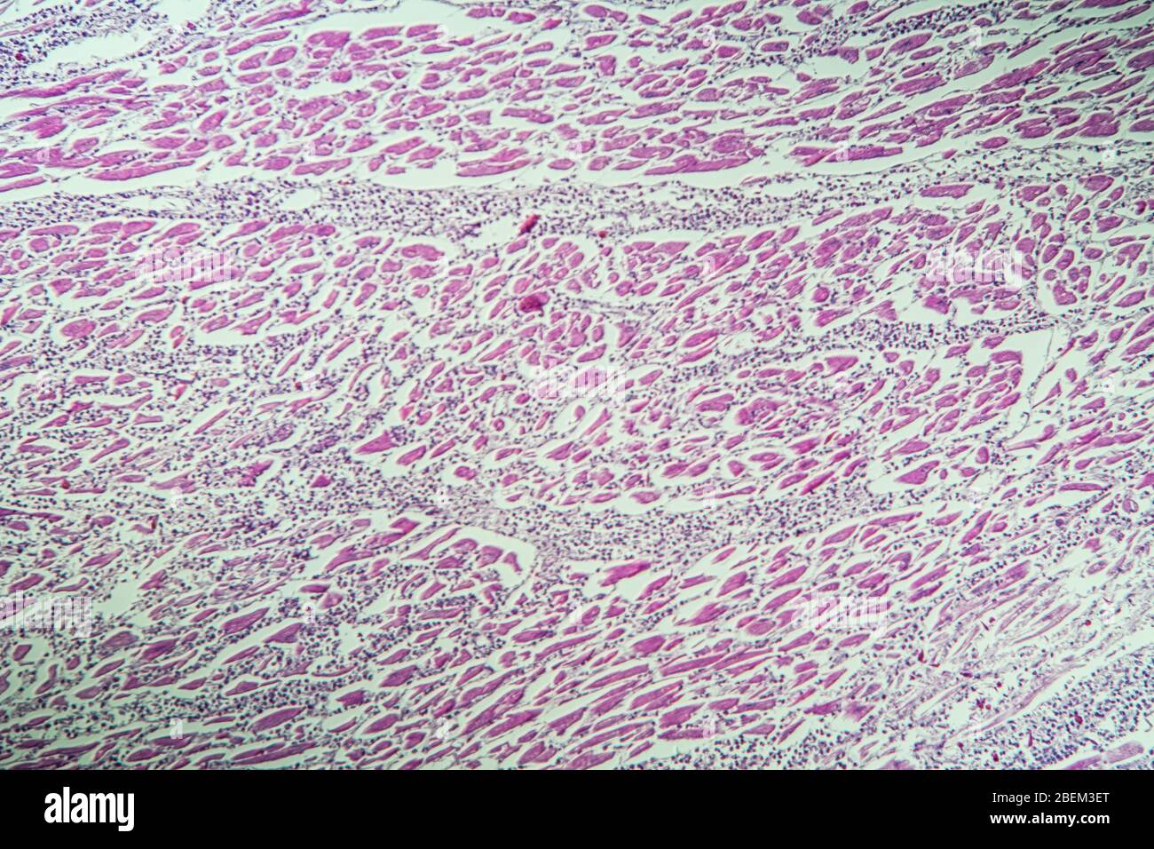 inflamed heart muscle as myocarditis 100x Stock Photo - Alamy