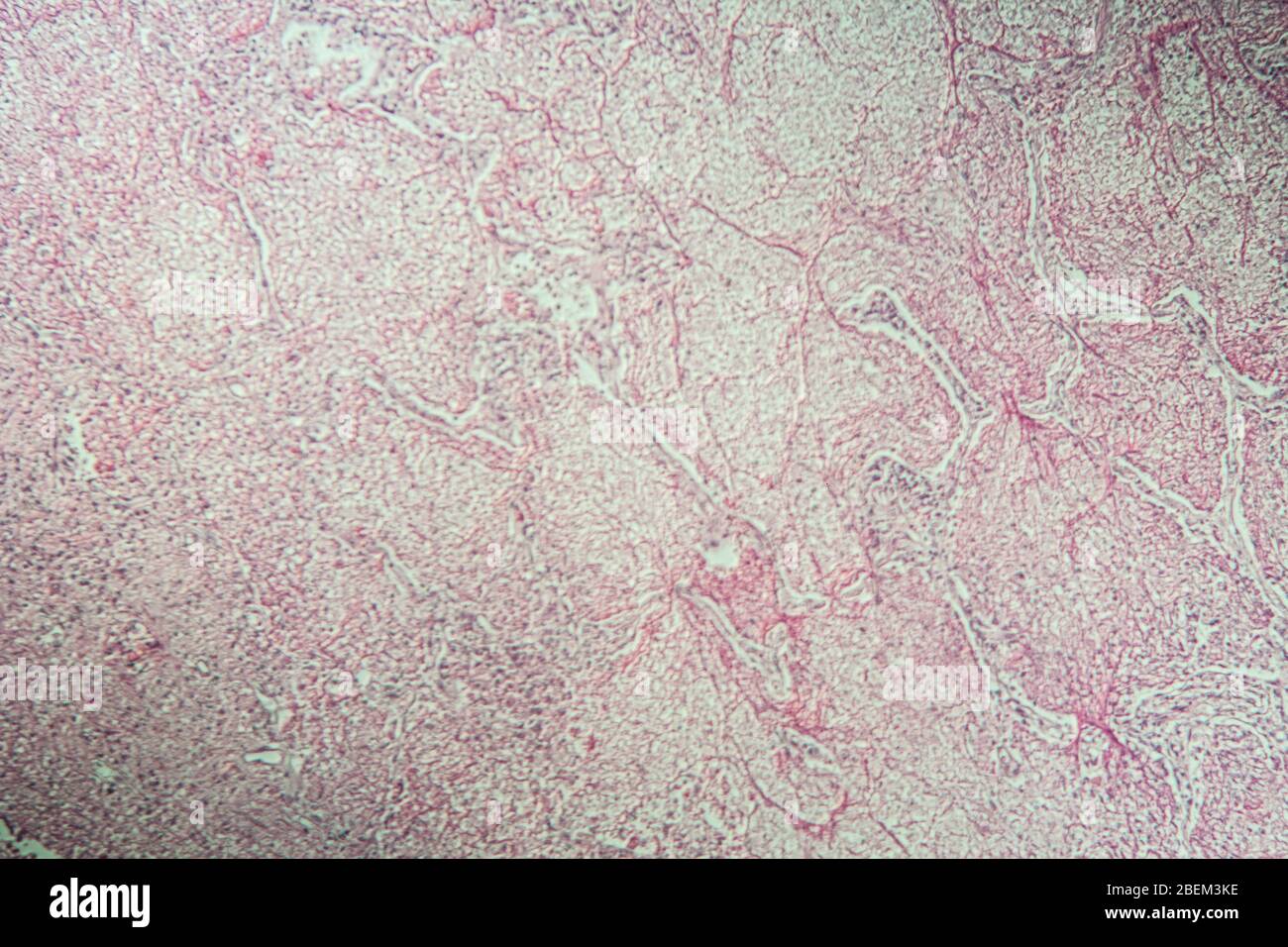 Tissue inflammation microscope hi-res stock photography and images - Alamy