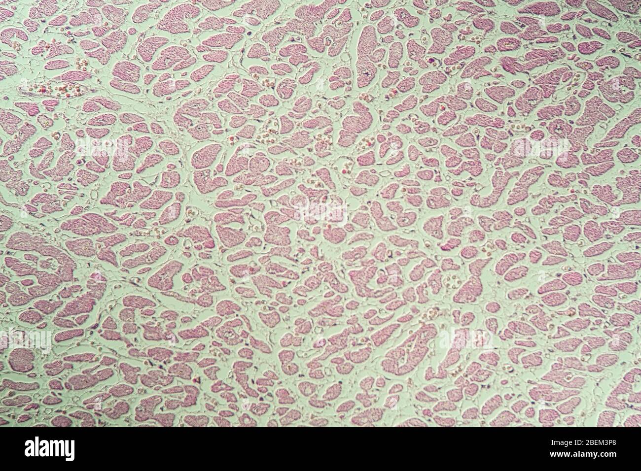 inflamed heart muscle sick tissue under the microscope 200x Stock Photo ...