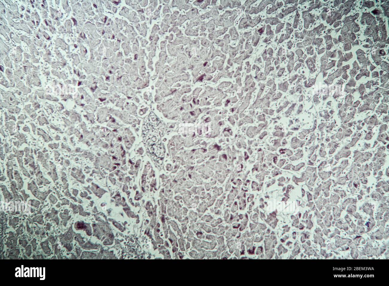 Hepatitis marker of sick tissue under the microscope 100x Stock Photo ...