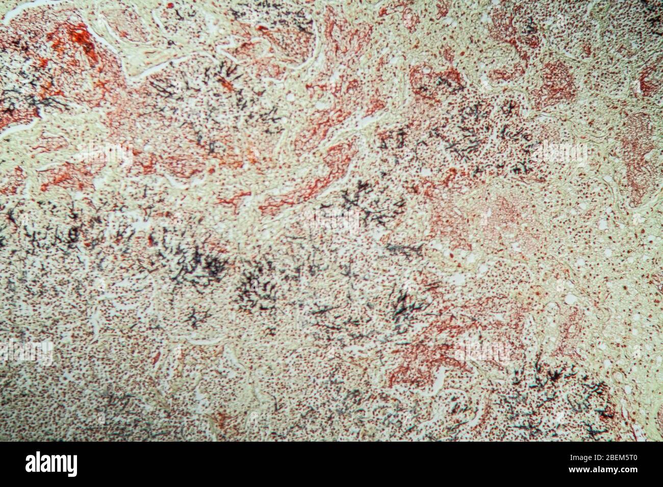 lungs Infection with Candida and Aspergillus in AIDS patients 200x ...