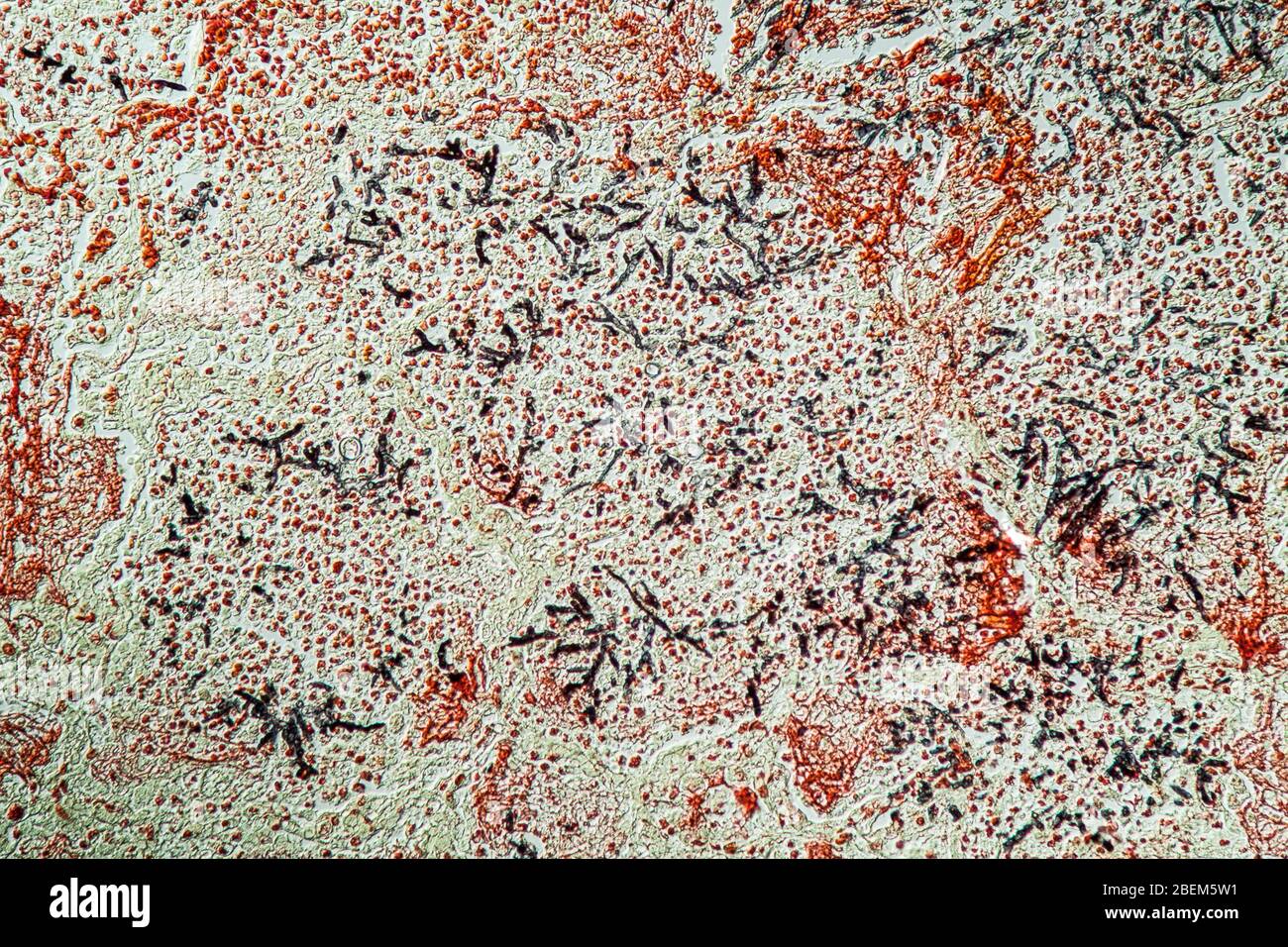 Infection with candida and aspergillus 200x hi-res stock photography ...