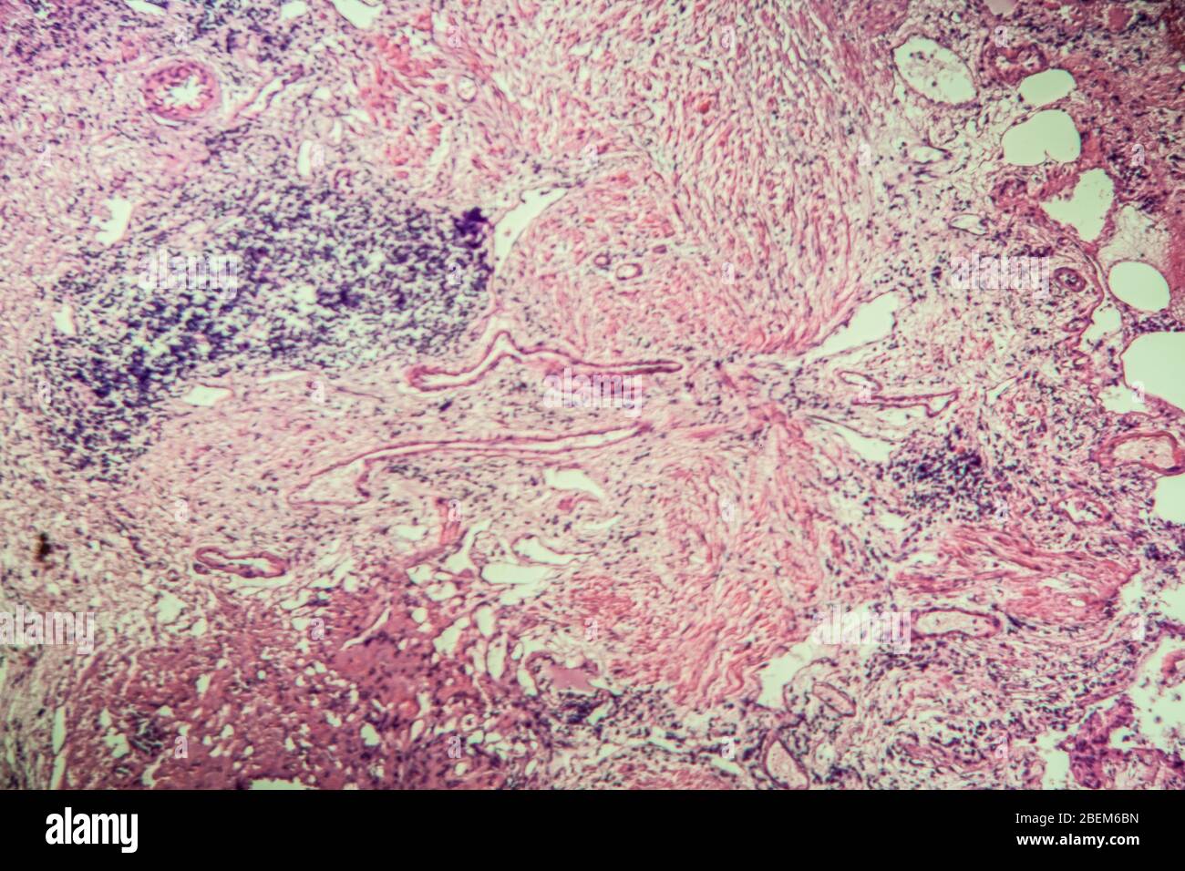 Salivary gland swollen diseased tissue under the microscope 100x Stock ...