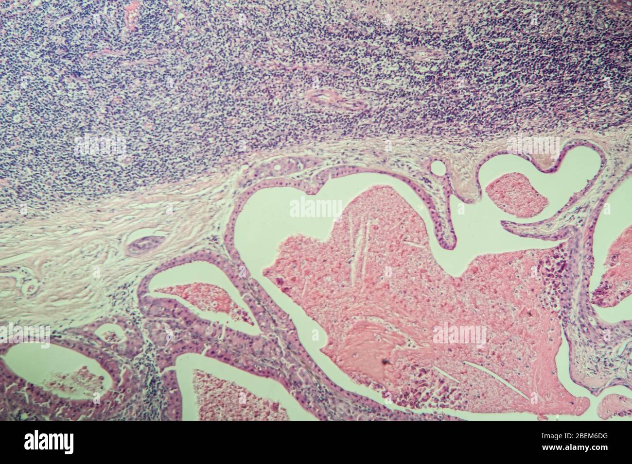 Salivary gland swollen diseased tissue under the microscope 100x Stock ...