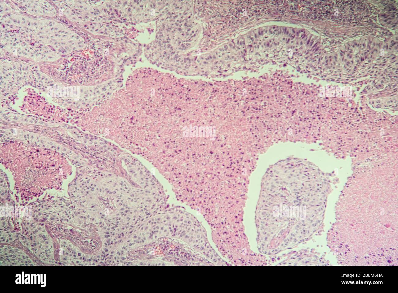 Squamous cell carcinoma diseased tissue under the microscope 100x Stock ...
